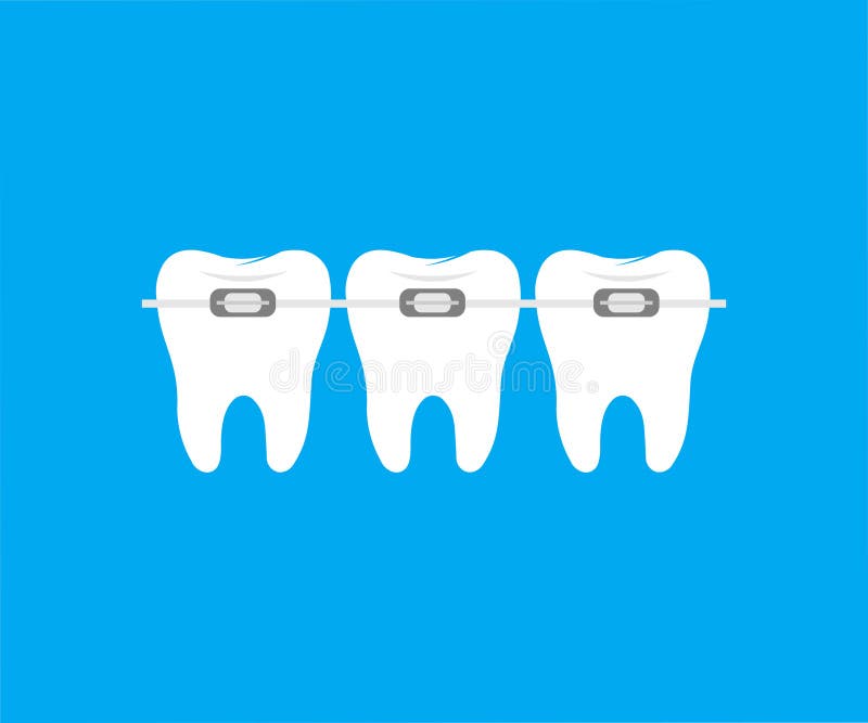Clear Ceramic Braces Stock Illustrations – 234 Clear Ceramic Braces ...