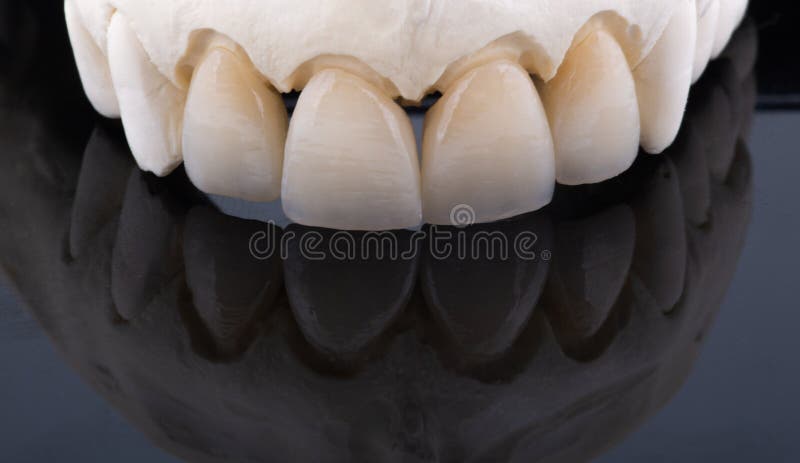 Teeth plaster cast stock photo. Image of restoration - 12677874