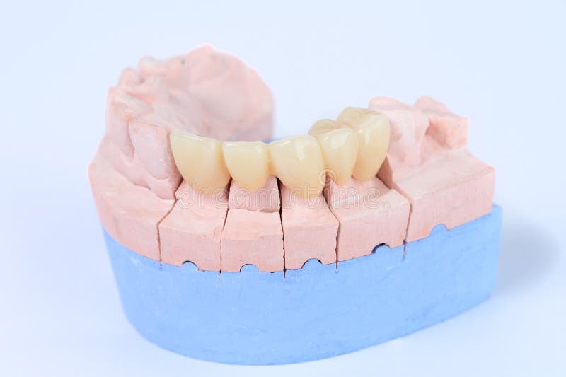 Ceramic Tooth Crown on Plaster Model Stock Photo - Image of close ...