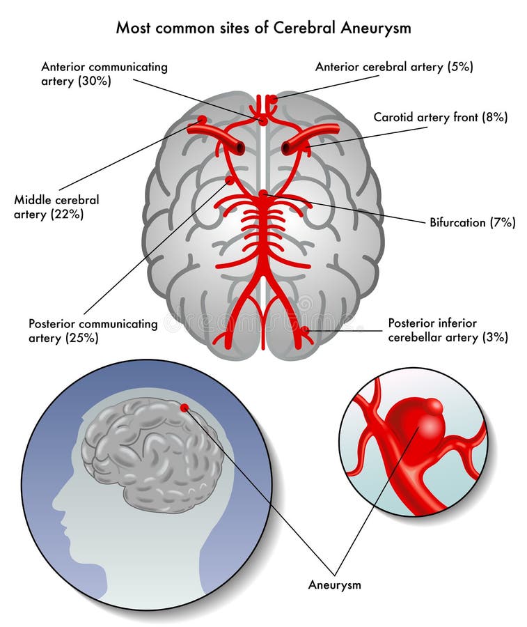 Brain Aneurysm Types Brain Aneurysm Types