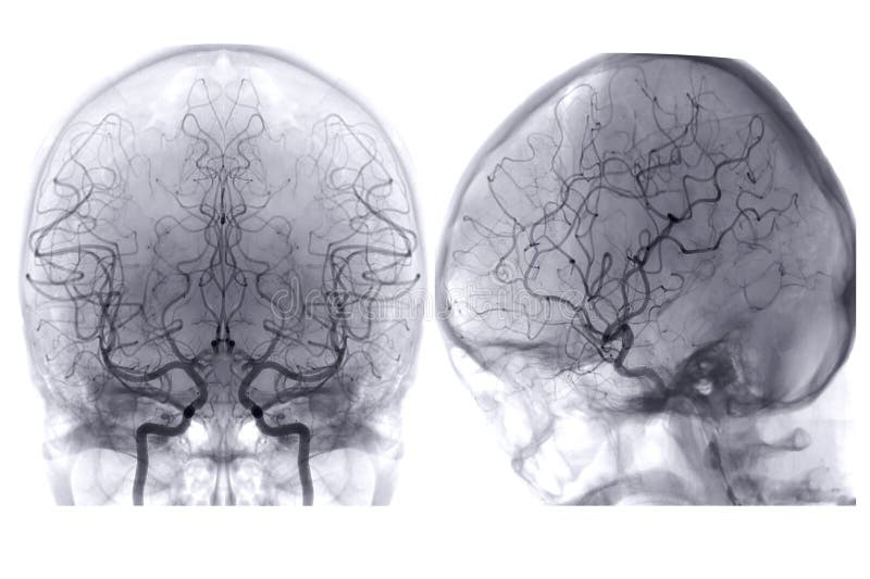 Cerebral Angiography Image from Fluoroscopy in Intervention Radiology ...