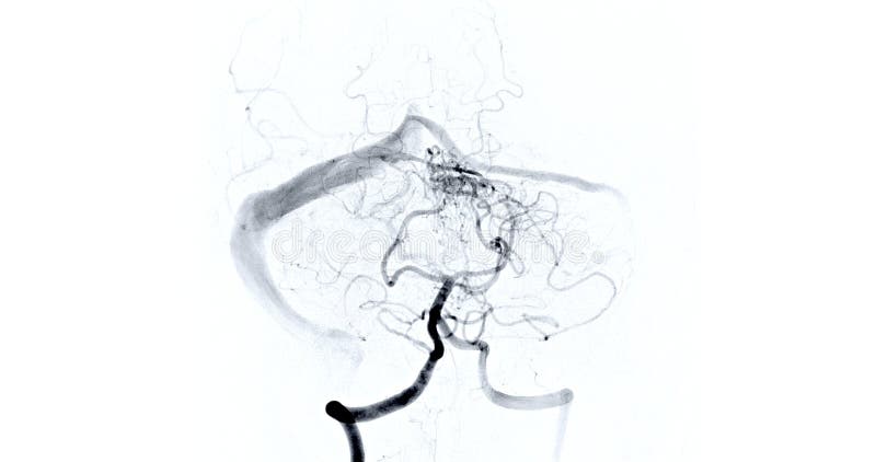 Cerebral Angiography Image from Fluoroscopy in Intervention Radiology ...