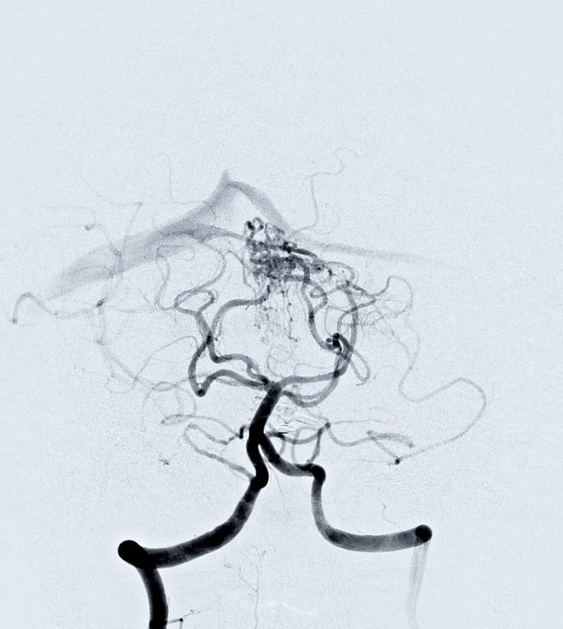 Cerebral Angiography Image from Fluoroscopy in Intervention Radiology ...