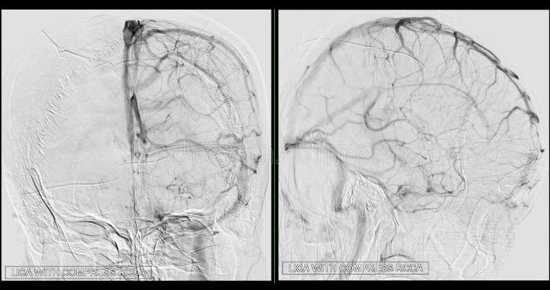 Cerebral Angiography Image from Fluoroscopy in Intervention Radiology ...