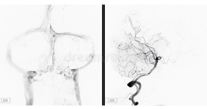 Cerebral Angiography Image from Fluoroscopy in Intervention Radiology ...