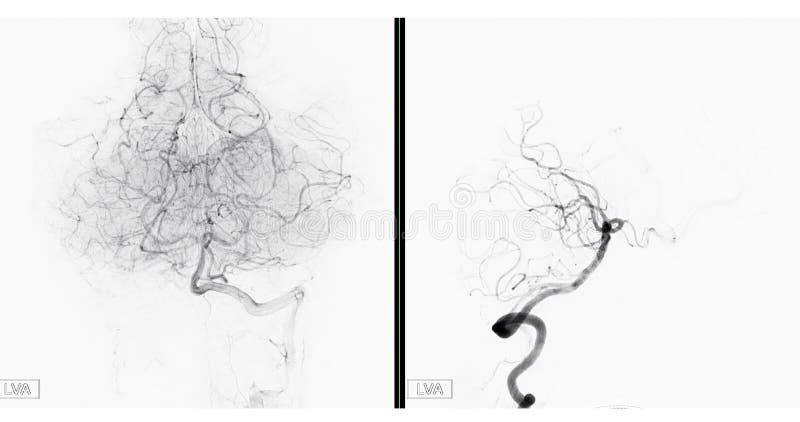Cerebral Angiography Image from Fluoroscopy in Intervention Radiology ...