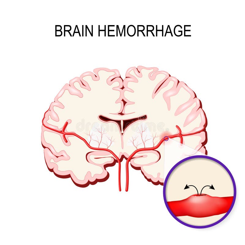 Diagram Of Human Brain Hemorrhage Stock Vector - Illustration of ...