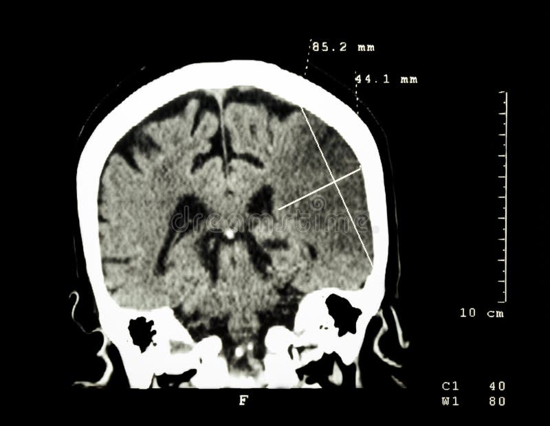 Ischemic Stroke : ( CT of Brain Show Cerebral Infarction at Left ...