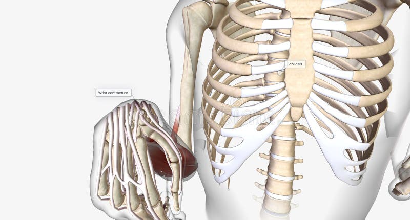 The Cerebral Palsy, Wrist Conracture Stock Illustration - Illustration ...