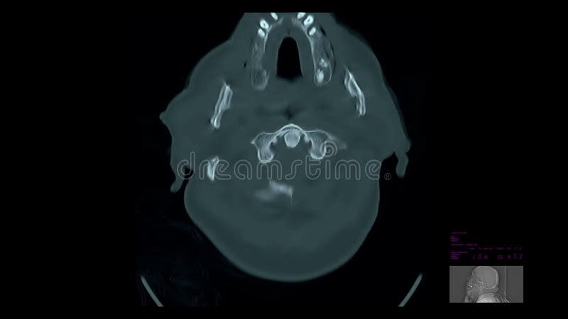 Cerebral venous congestion stock video footage. Video of exam - 38536484