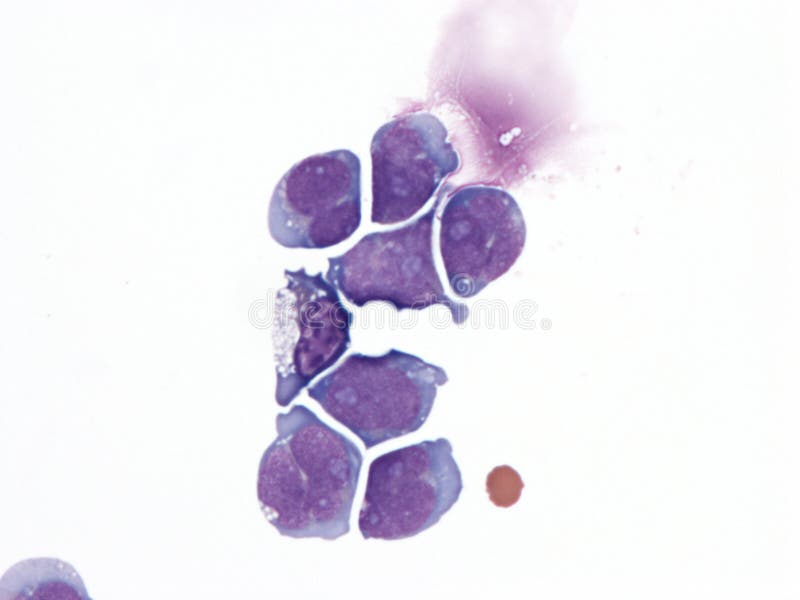 Diffuse Large B Cell Lymphoma with Meningeal Involvement. Stock Photo ...