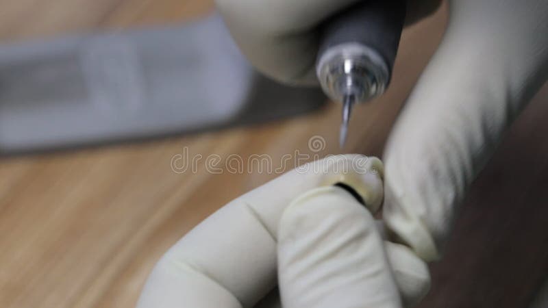 Cermet Implant Creation Process at Laboratory. Stock Video - Video of ...