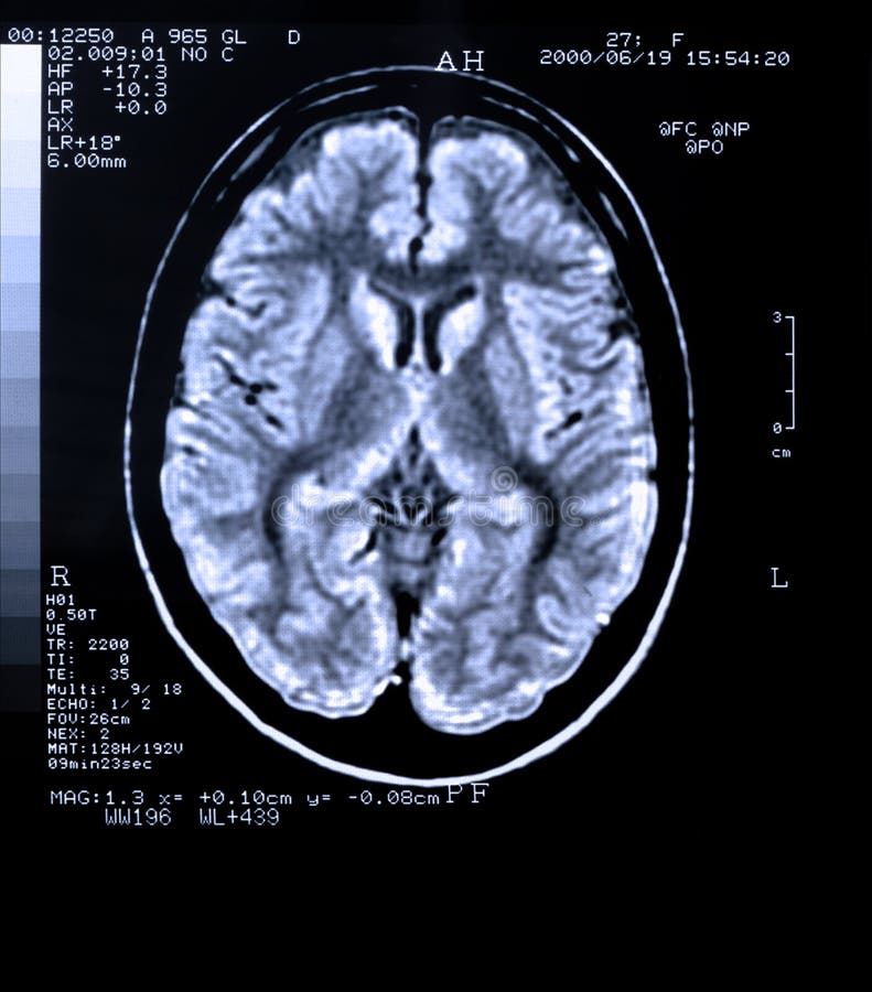 Image IRM Du Cerveau De Représentation Principal Image stock - Image du ...