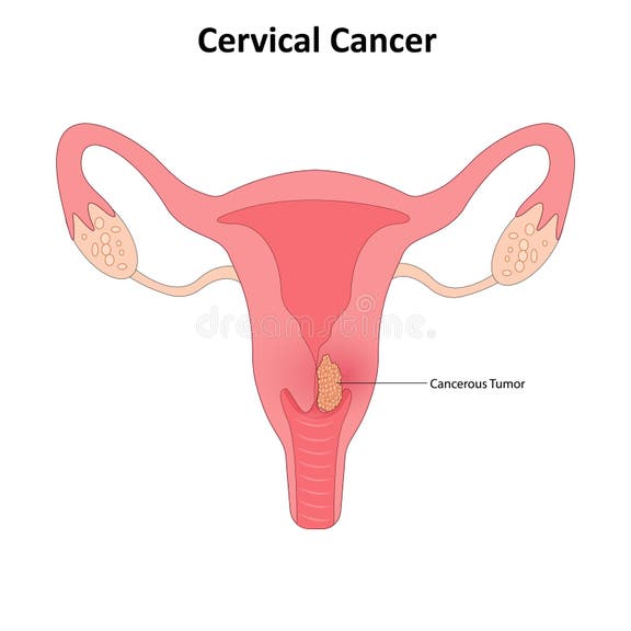 Cervical Cancer Progression Stock Illustrations – 13 Cervical Cancer ...