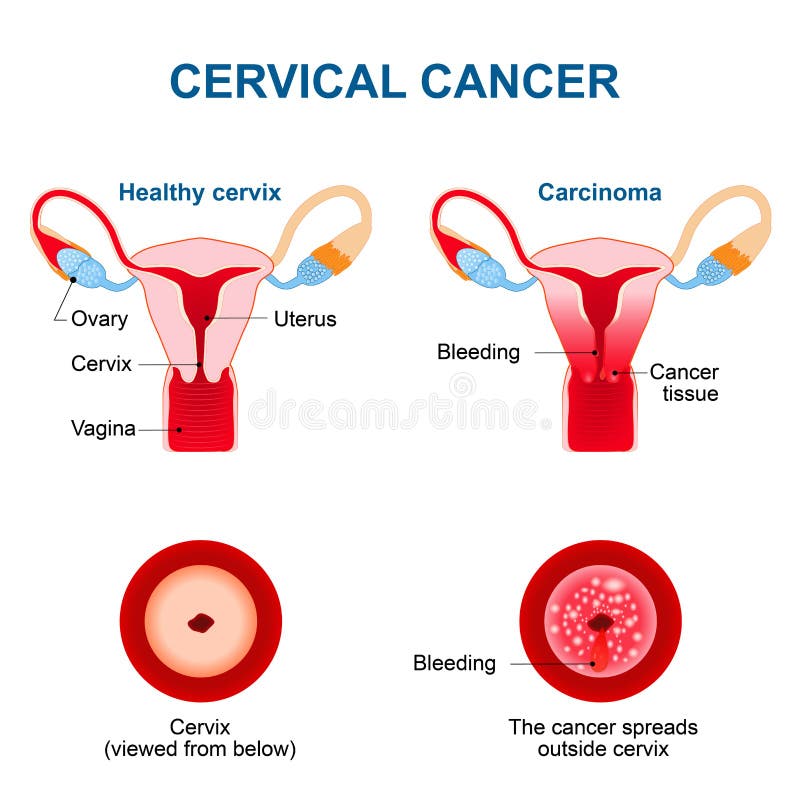 Cervical Cancer Carcinoma Of Cervix Stock Vector Illustration Of