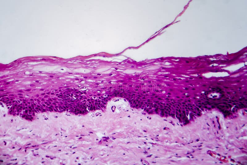 Cervical Ectropion, Light Micrograph Stock Photo - Image of disease ...