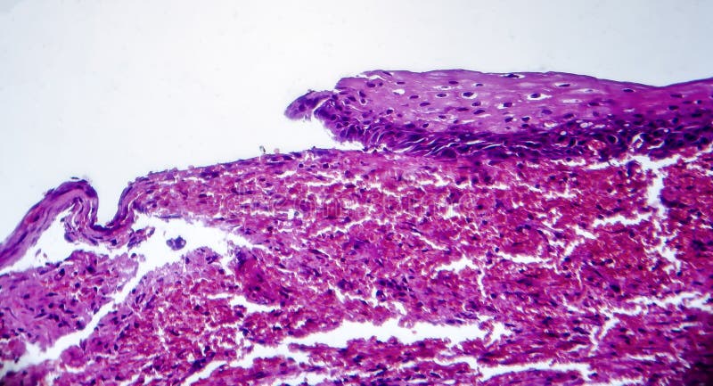 Cervical Ectropion, Light Micrograph Stock Image - Image of cervical ...