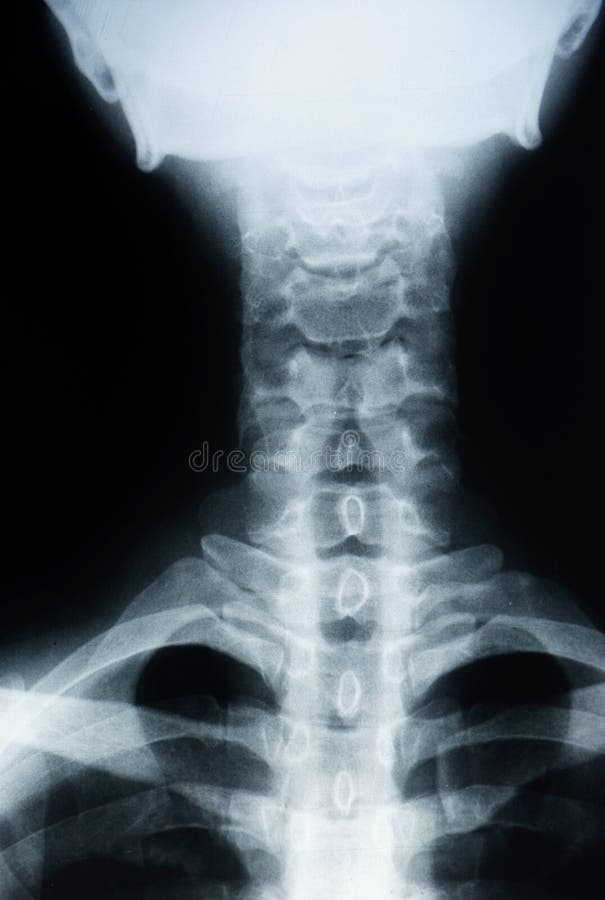 Lumbar Spine X-Ray with Slight S-shaped Skoliosis Stock Photo - Image ...
