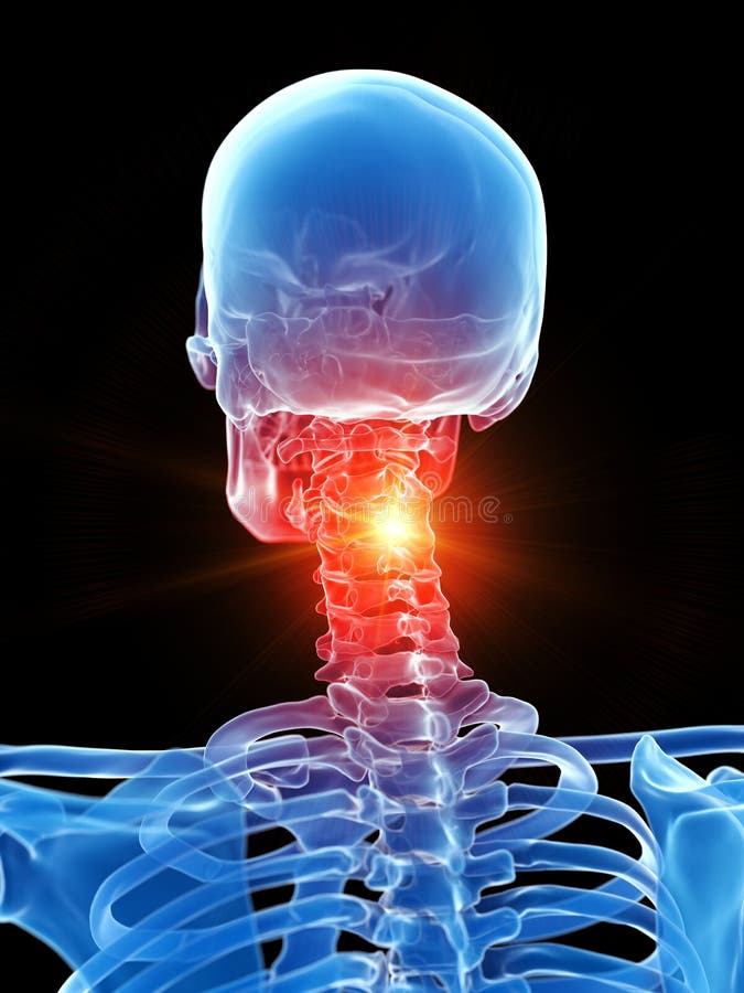 Neck Pain Cervical Spine at Eden Goldfinch blog