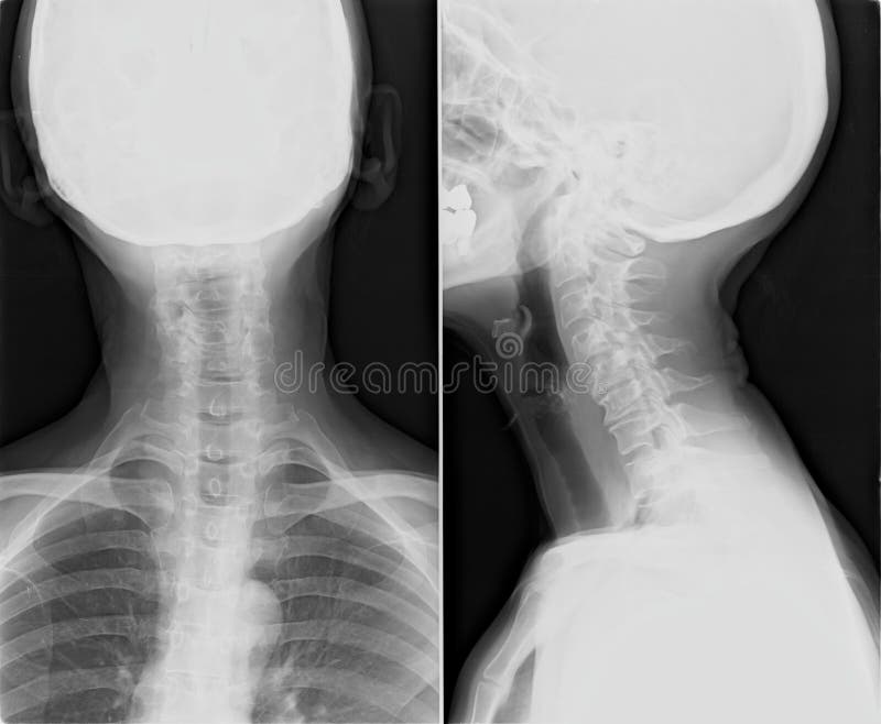 Cervical spine xray stock photo. Image of side, diagnostics - 142599516