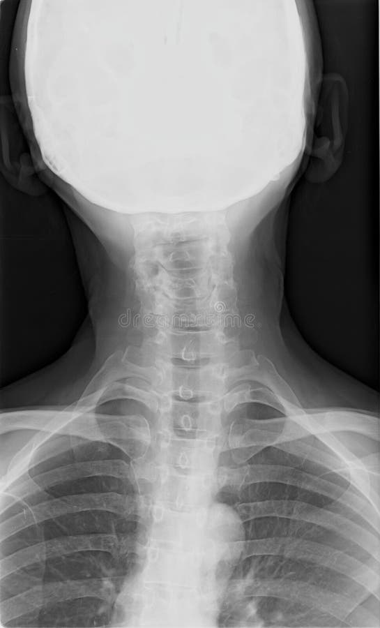 Cervical spine xray stock image. Image of head, bone - 150202981
