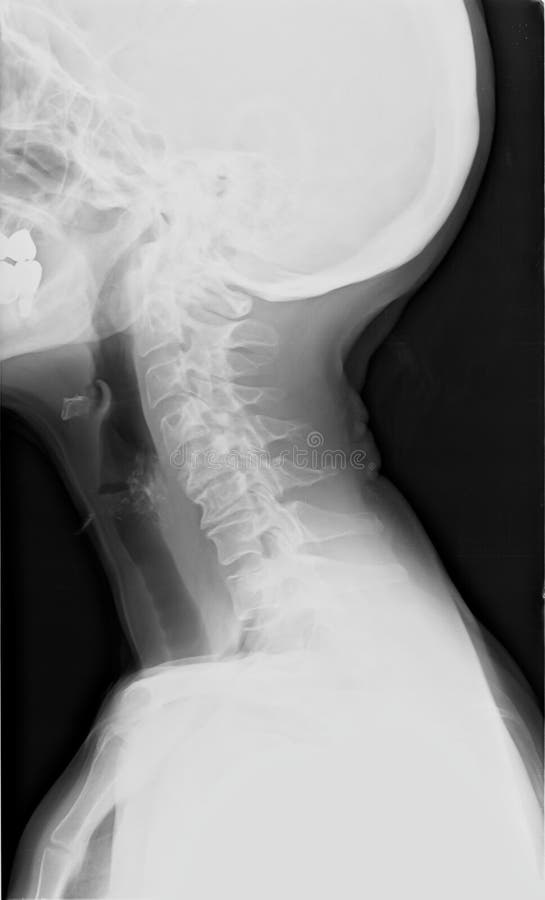 Cervical spine xray stock photo. Image of skeleton, medicine - 150203814