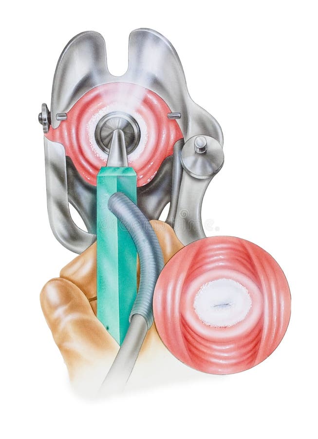 Cervix - Cryosurgery of Cervical Lesions Stock Illustration ...