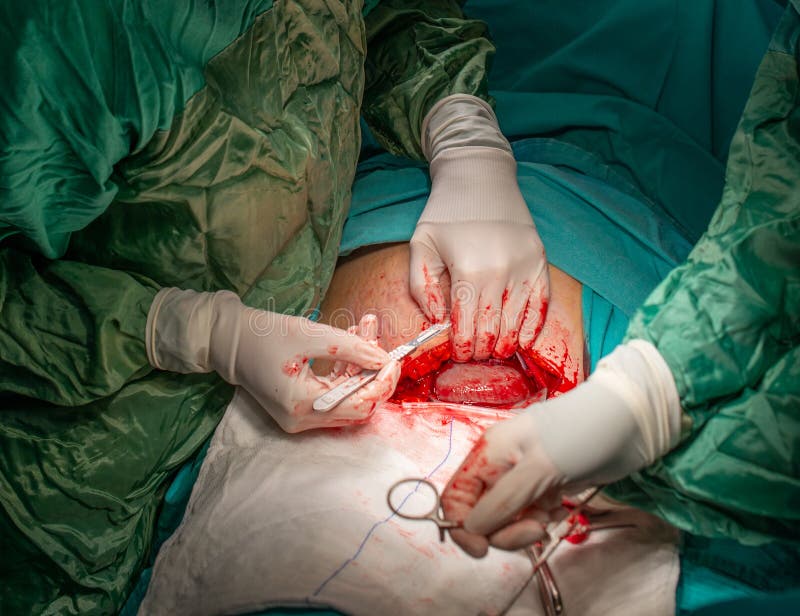 Cesarean Section in Progress: a Glimpse Inside the Operating Room Stock ...