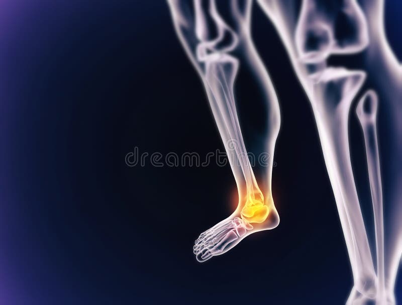 When Inflammation Strikes. a Cgi View of an Inflamed Joint Isolated on ...