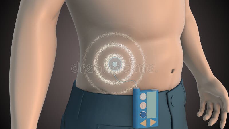 Blood Glucose Regulation Using Automated Insulin Pump Stock ...