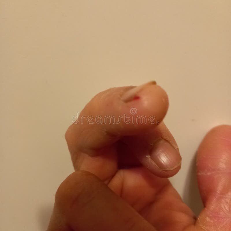 Chaffed Finger Stock Photos - Free & Royalty-Free Stock Photos from ...