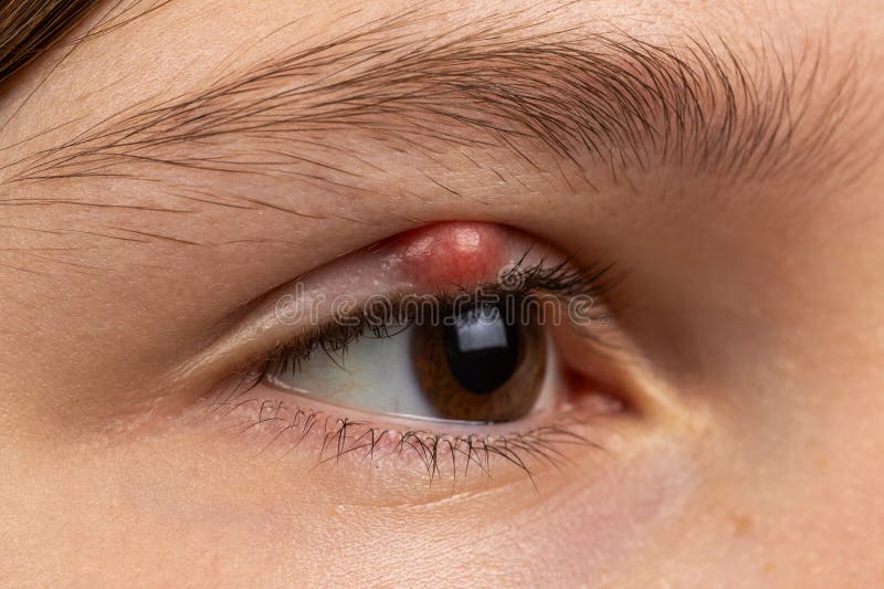 Chalazion on the Eyelid of a Girl Close-up Stock Image - Image of ...