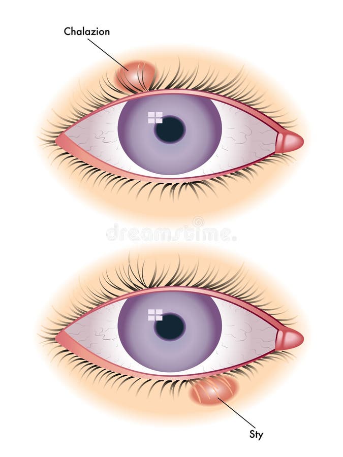 Chalazion & vagel vektor illustrationer. Illustration av blockering ...