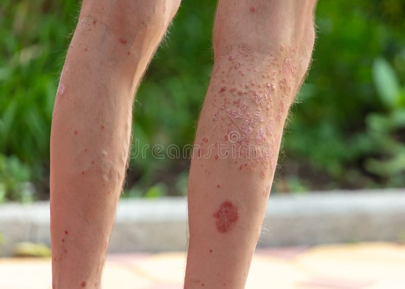 229 Photos de Eczema Sur La Jambe - Photos de stock gratuites et libres ...