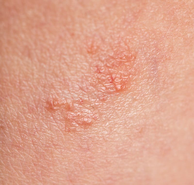 Microsporia Un Champignon Sur La Peau Du Bras Photo stock - Image du ...