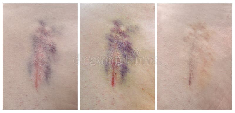 Hematoma of tissue stock photo. Image of painful, bruise - 149414492