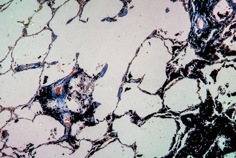 Charcoal dust lung tissue stock photo. Image of blue - 196729528