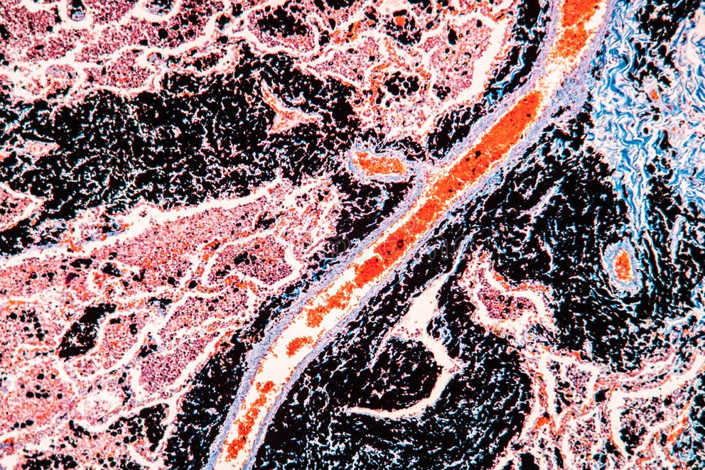 Charcoal dust lung tissue stock photo. Image of microscopy - 196729558