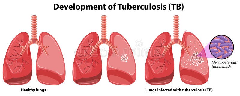 Tuberculosis Stock Illustrations – 5,539 Tuberculosis Stock ...