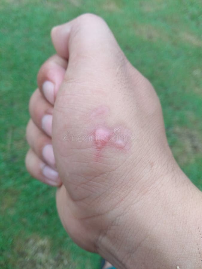 Equipaggi Il Braccio E La Mano Con La Cicatrice Di Cheloide & X28; Scar ...