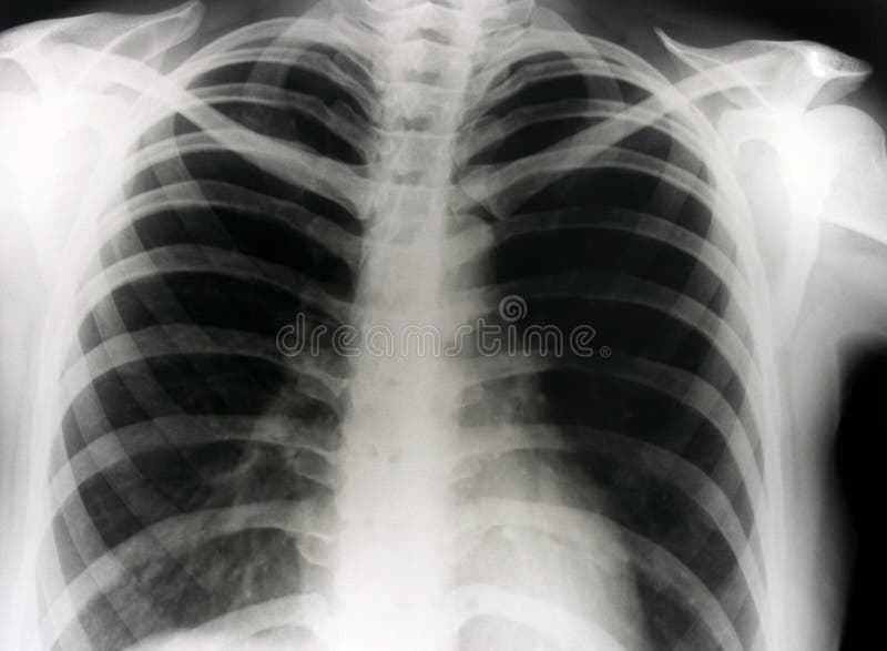 Chest stock photo. Image of human, diagnostic, diagnose - 678778