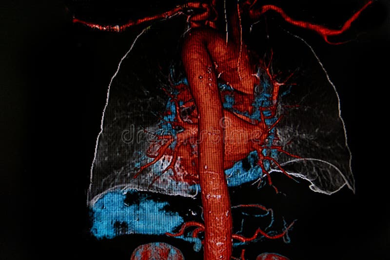 Chest Angiography. 3D Rendering Image Stock Image - Image of scan ...