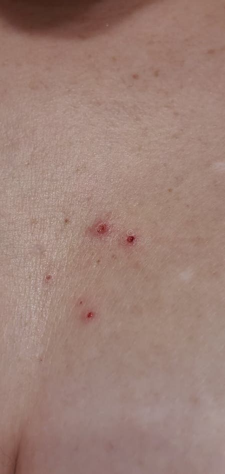 Chest Bug Bites stock photo. Image of bite, skin, bites - 244114440