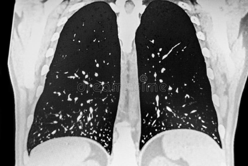 Chest CT- Scan Showing Multiple Small Lesions Compatible with Pulmonary ... Chest CT- Scan Showing Multiple Small Lesions Compatible with Pulmonary ...