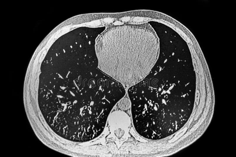 Chest Ct Scan Showing Multiple Small Lesions Compatible With Pulmonary