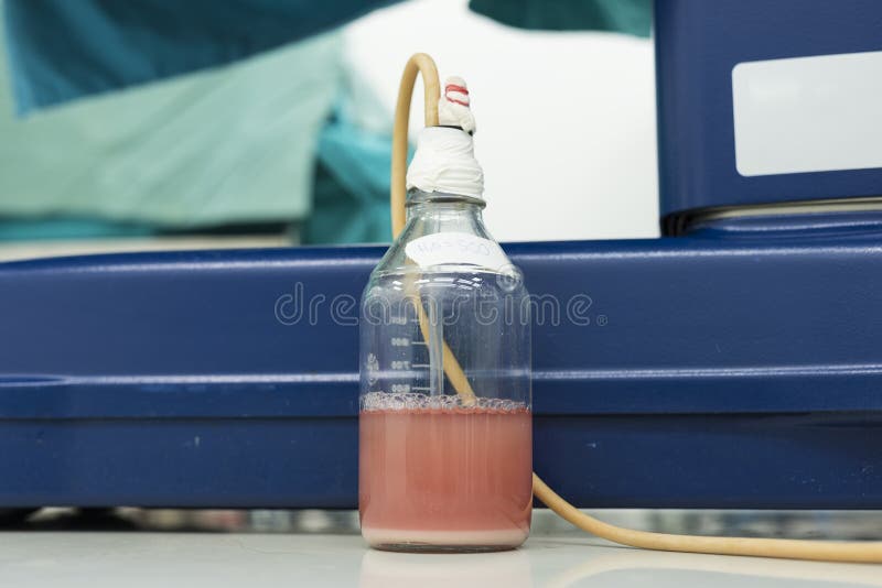 One Bottle System Intercostal Drainage Stock Photo - Image of closeup ...