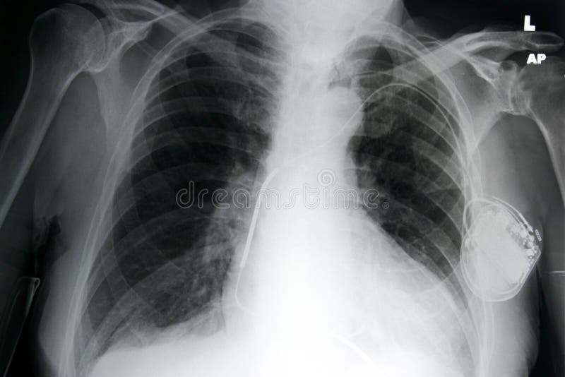 Chest+pacemaker stock image. Image of life, film, injury - 196851