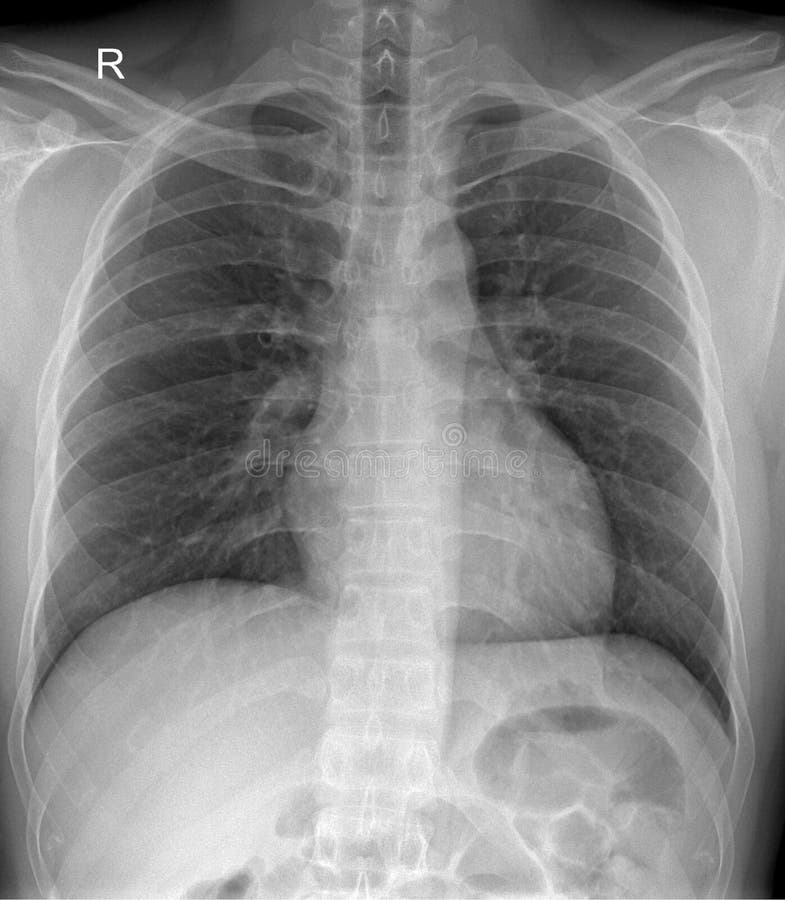 Chest Radiograph Posteroanterior View Stock Photo - Image of radiograph ...