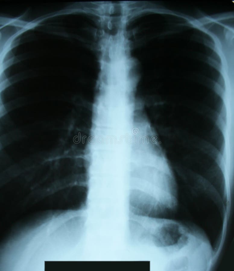 Chest radiograph rtg stock image. Image of skeleton, black - 13333247