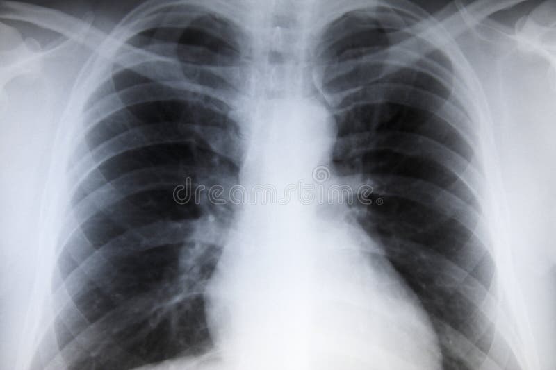 Chest x-ray stock image. Image of exam, technology, medical - 1812507